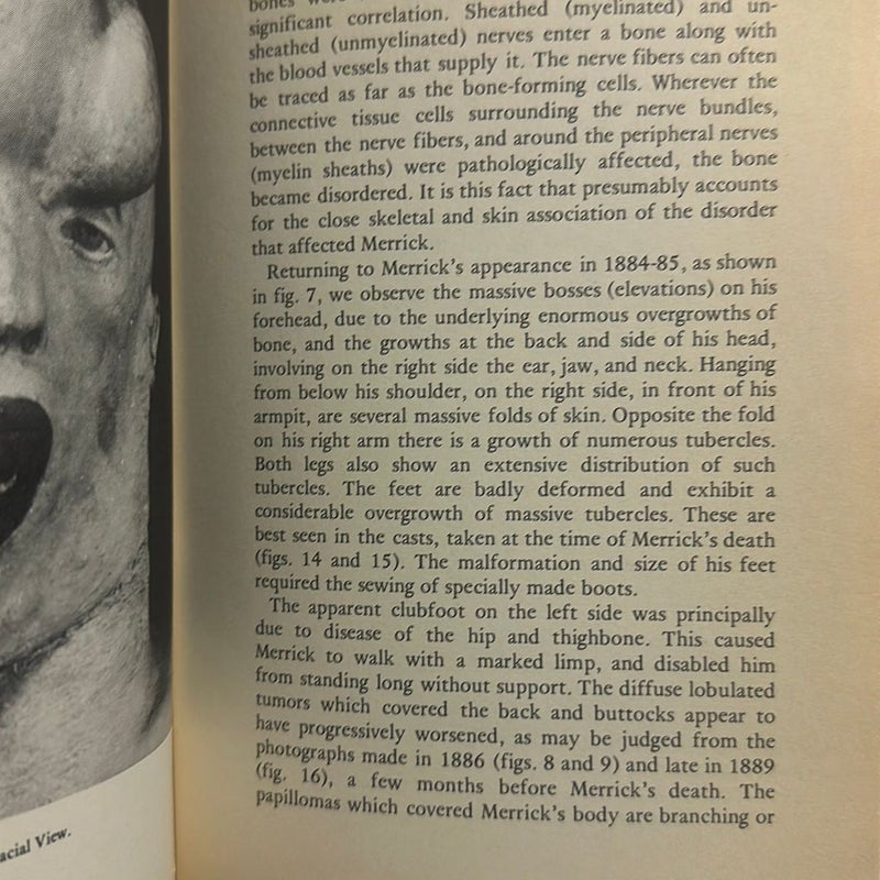 The Elephant Man by Frederick Treves, Hardcover | Pangobooks