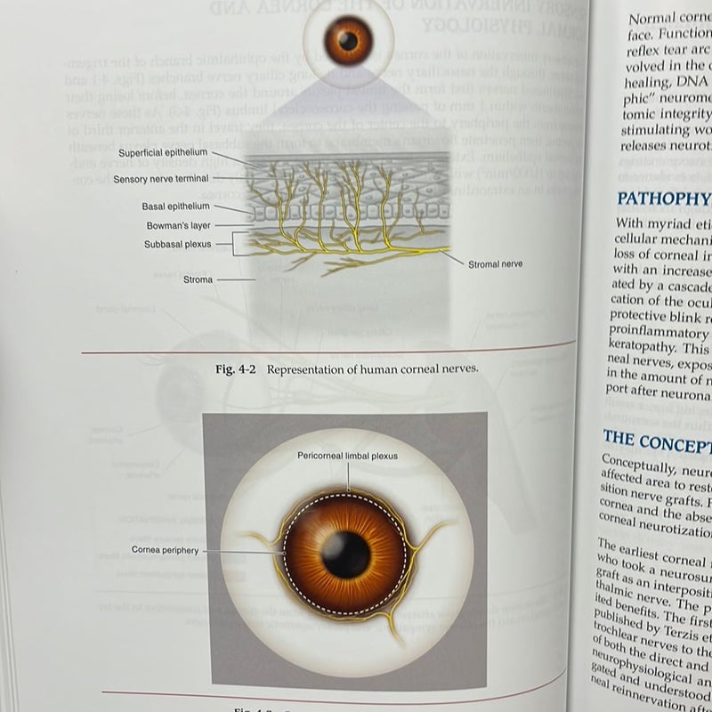 Techniques in Corneal Neurotization by Ilya M. Leyngold, Hardcover ...